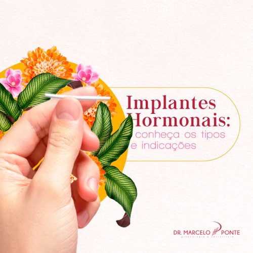 Implantes Hormonais Conheça Os Tipos E Indicações Dr Marcelo Ponte